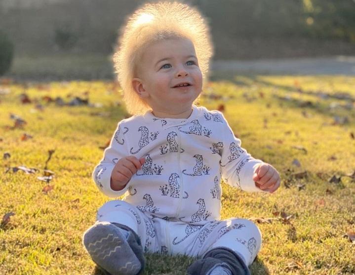 Qué es el síndrome del cabello impeinable y por qué se genera ...