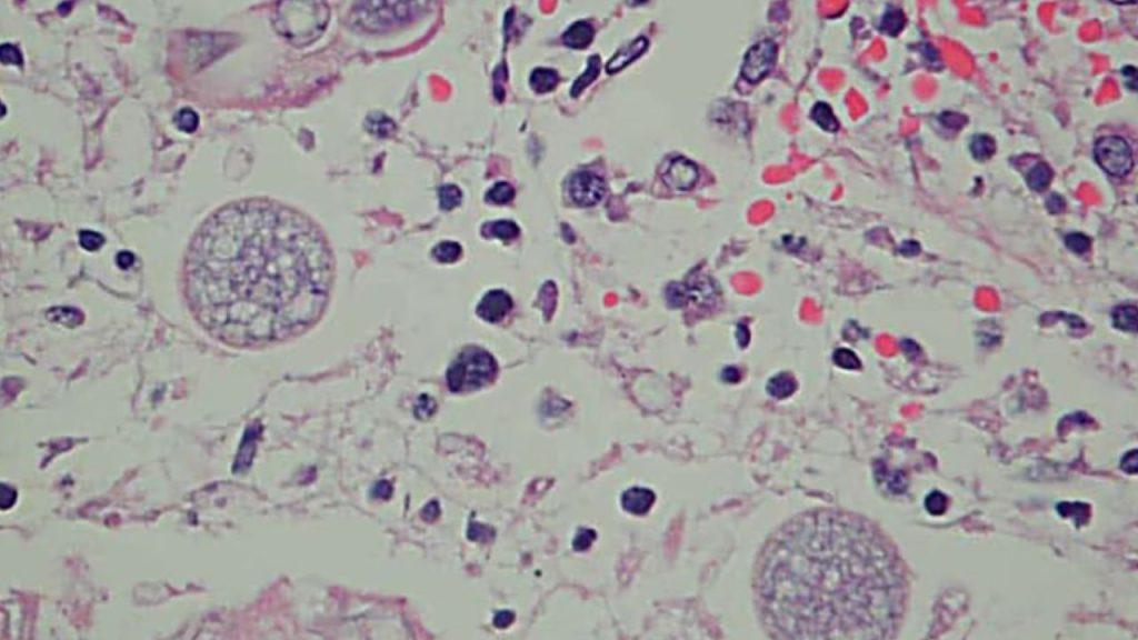 La infección por hongos que crece en América a causa del cambio climático